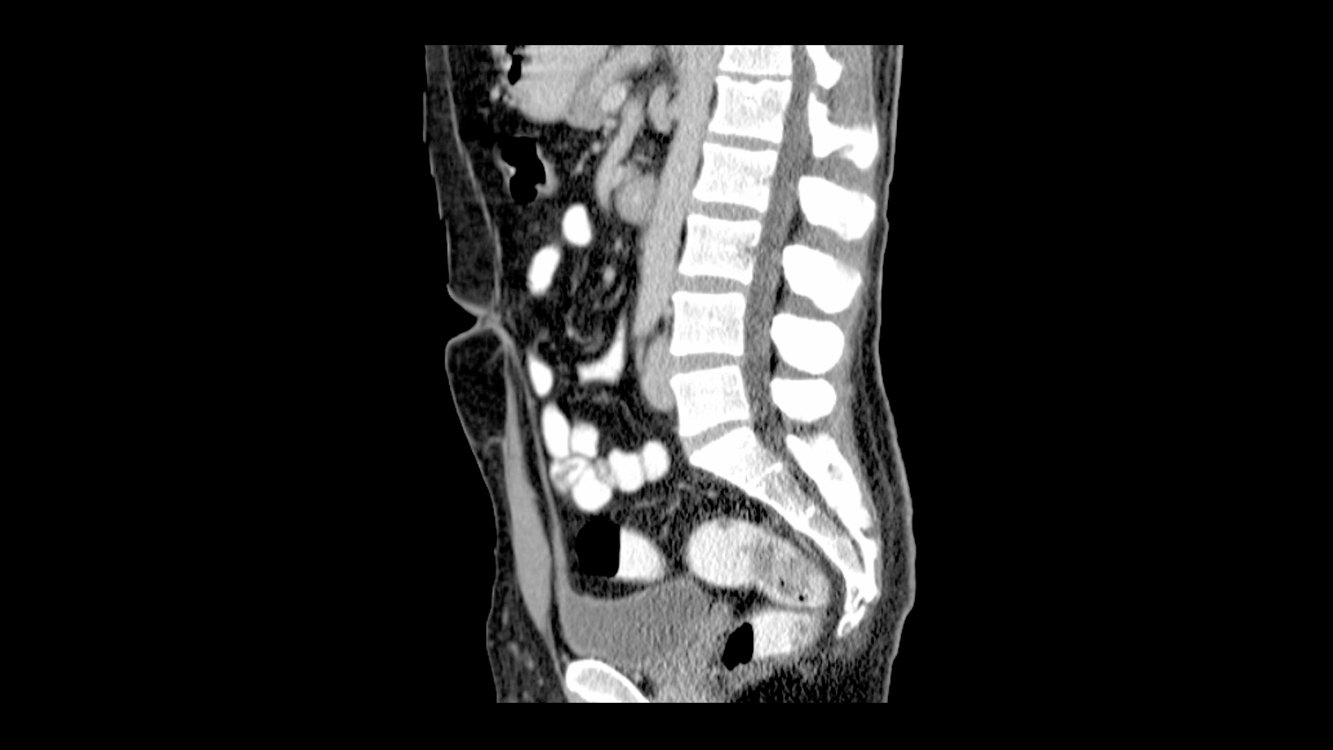 Urachal Cyst Nhs