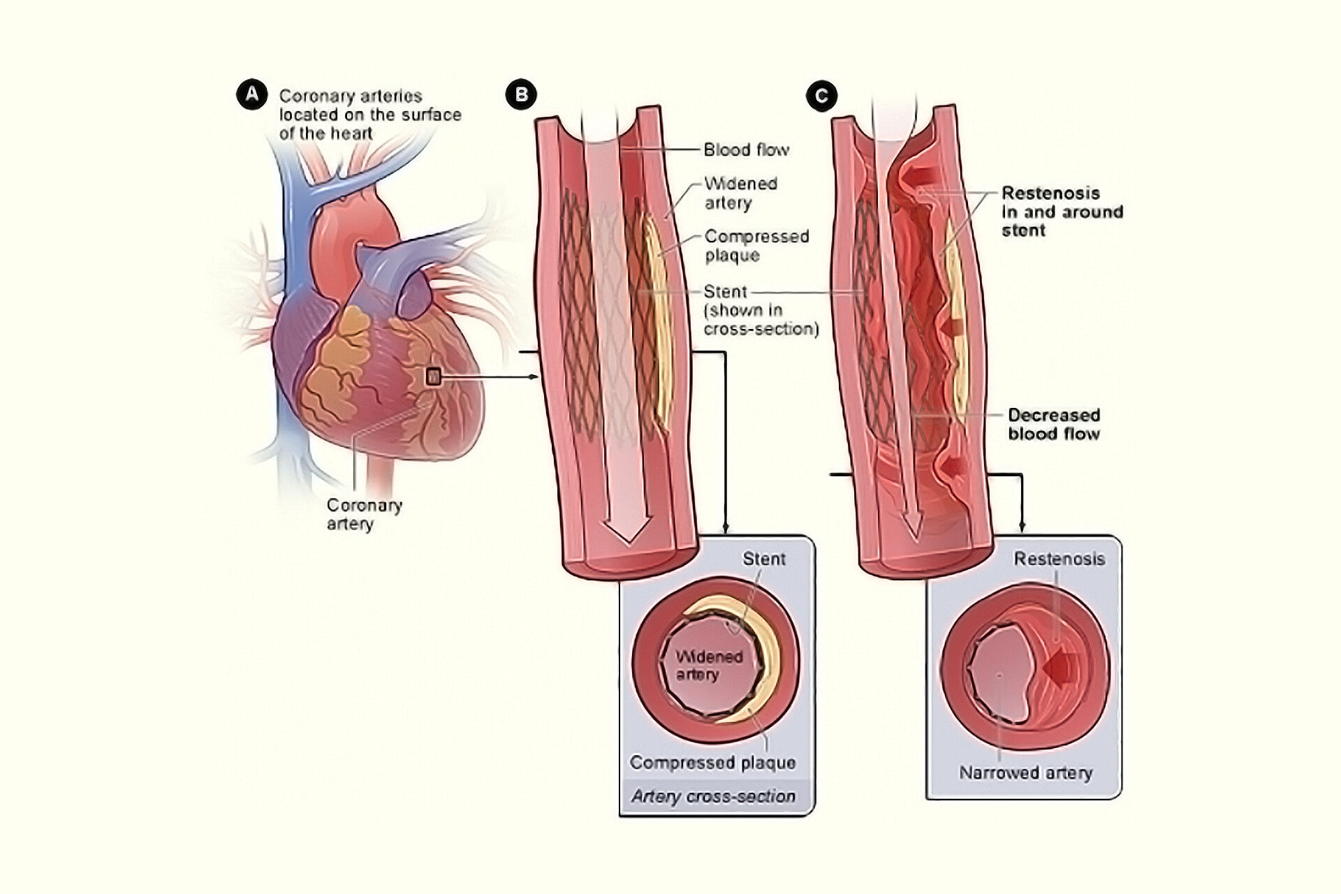 Coronary Artery Stent