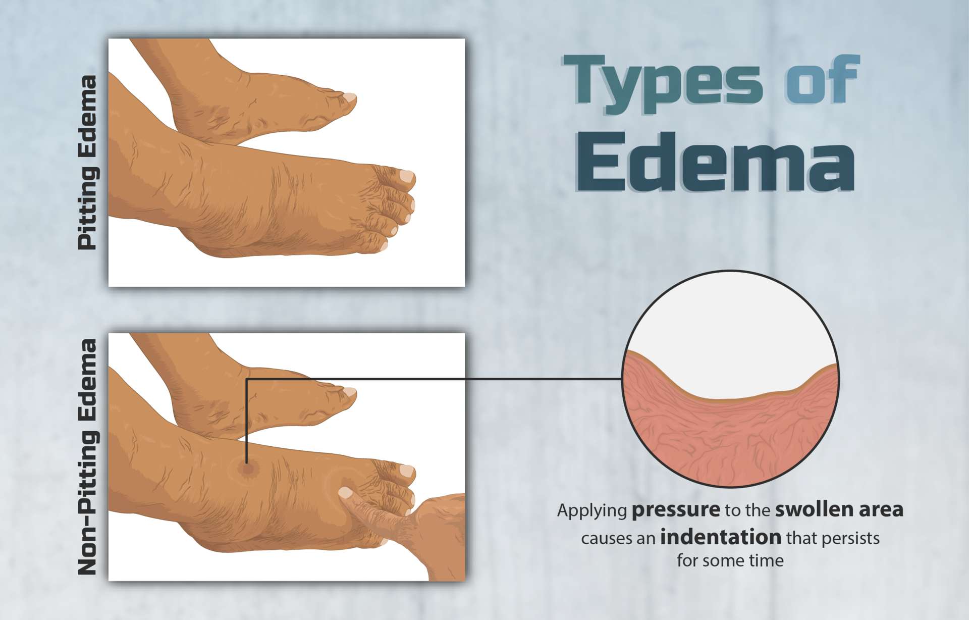 Sacral Area Edema