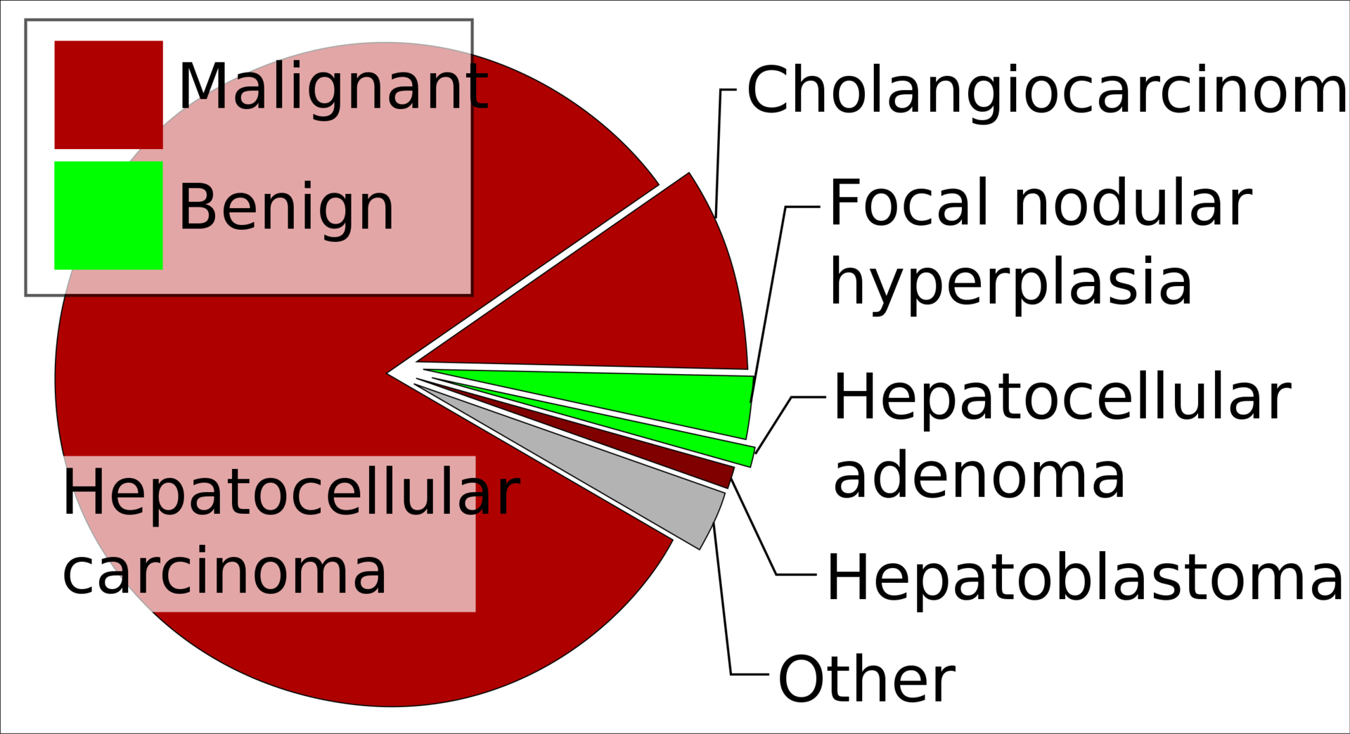 Liver Cancer Stages Four Stages Liver Cancer Steps Spread Stock Vector