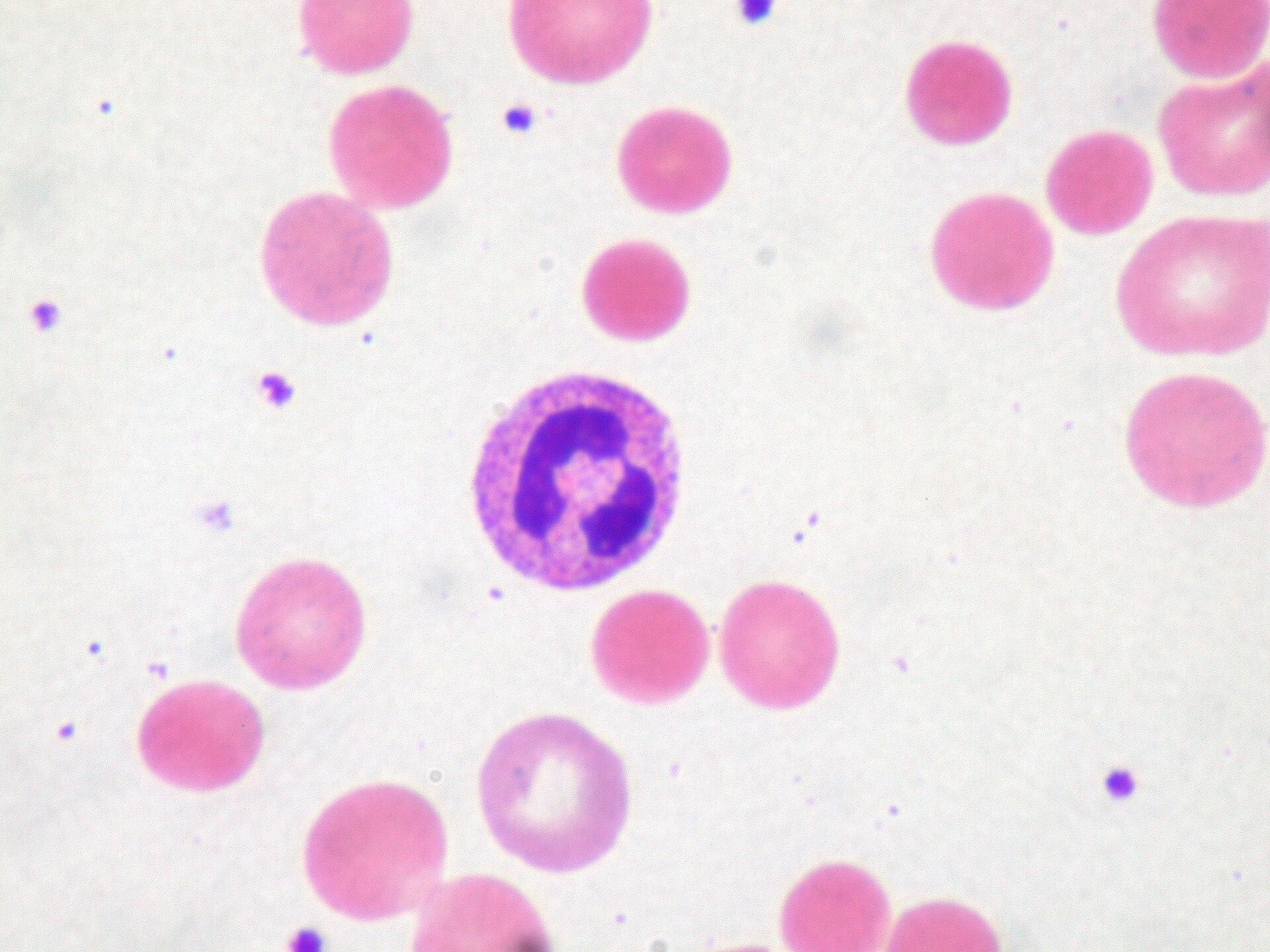 G6pd Deficiency Smear
