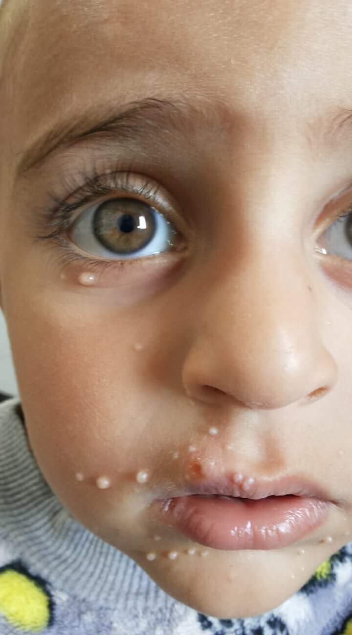 Molluscum Contagiosum Face