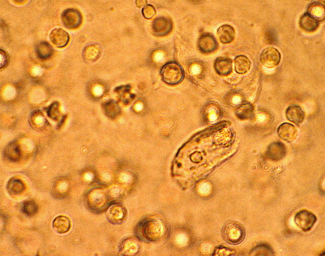 Red Cells In Urine Test An Accurate Urine Red Blood Cell Detection
