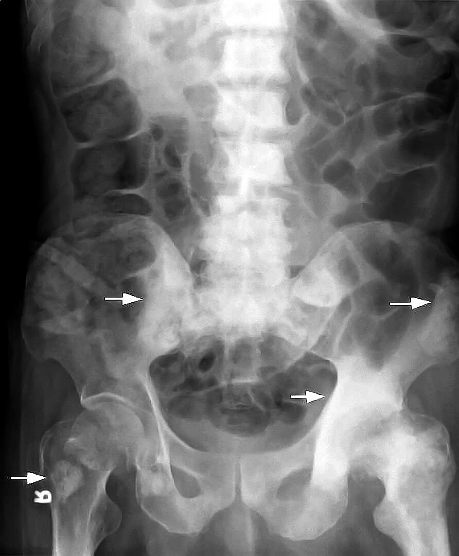 Benign Prostatic Hyperplasia X Ray