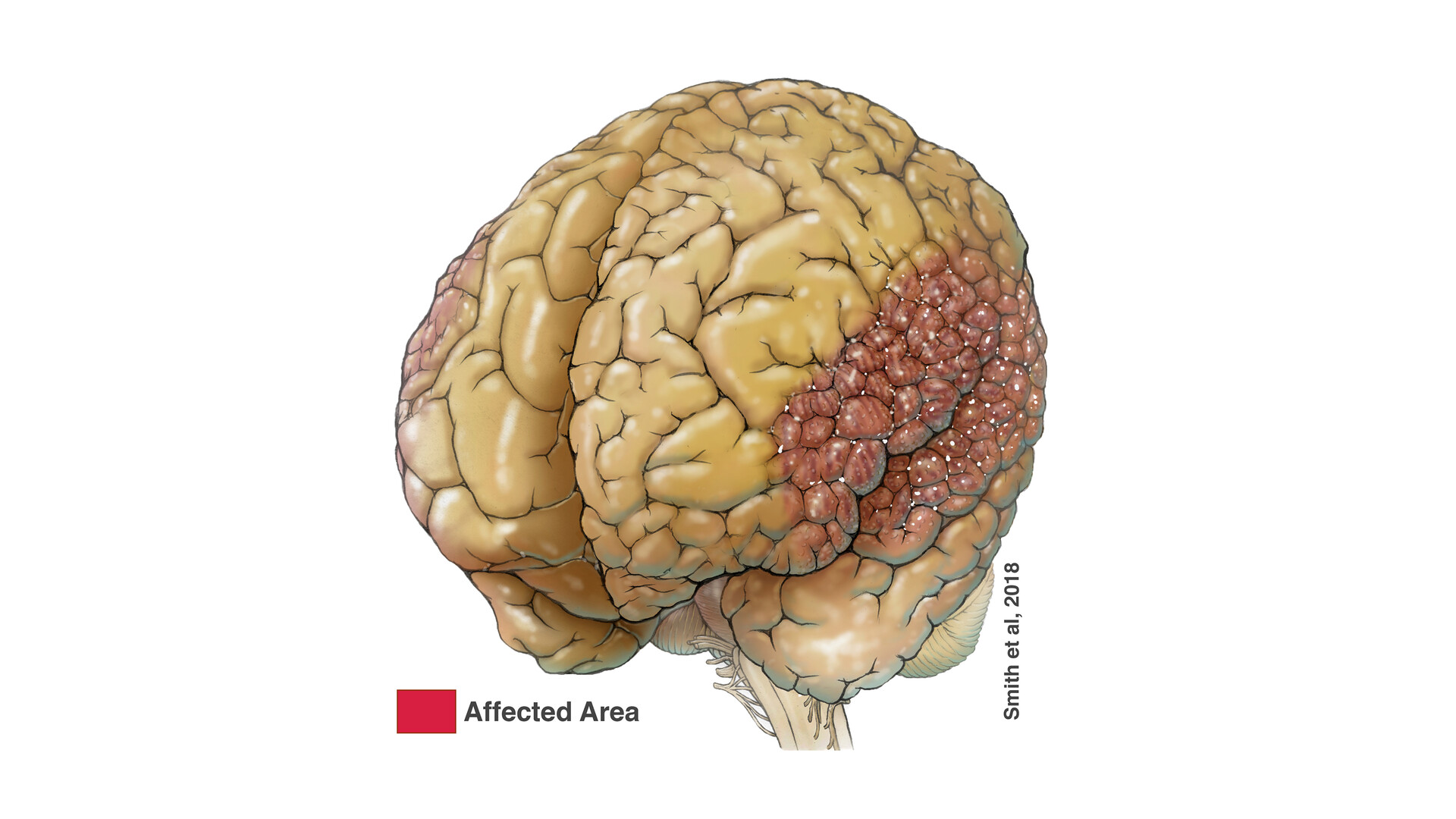 Megalencephaly Causes