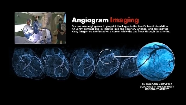 Angiography Blockage