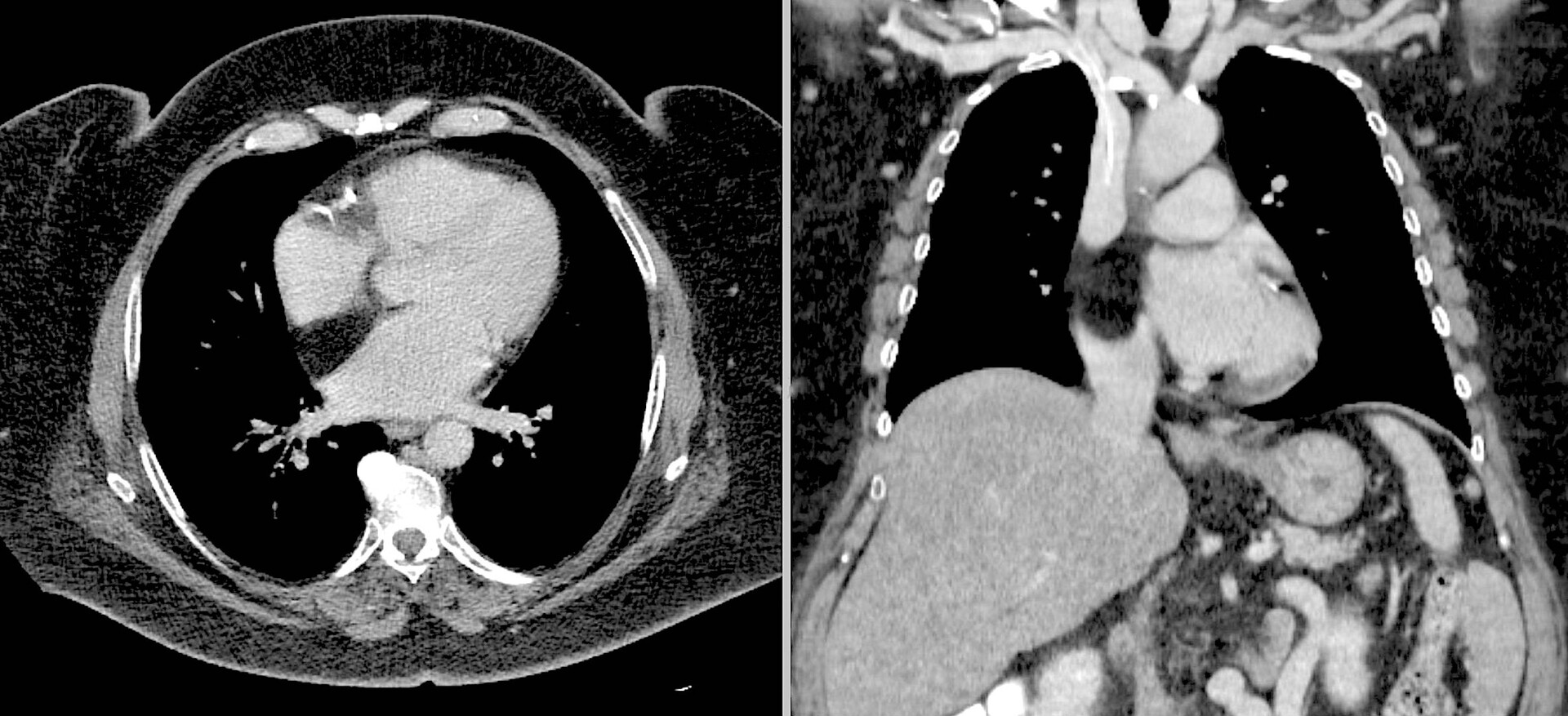 Cardiac CT Scan Why Is It Done And What The Results Mean StoryMD