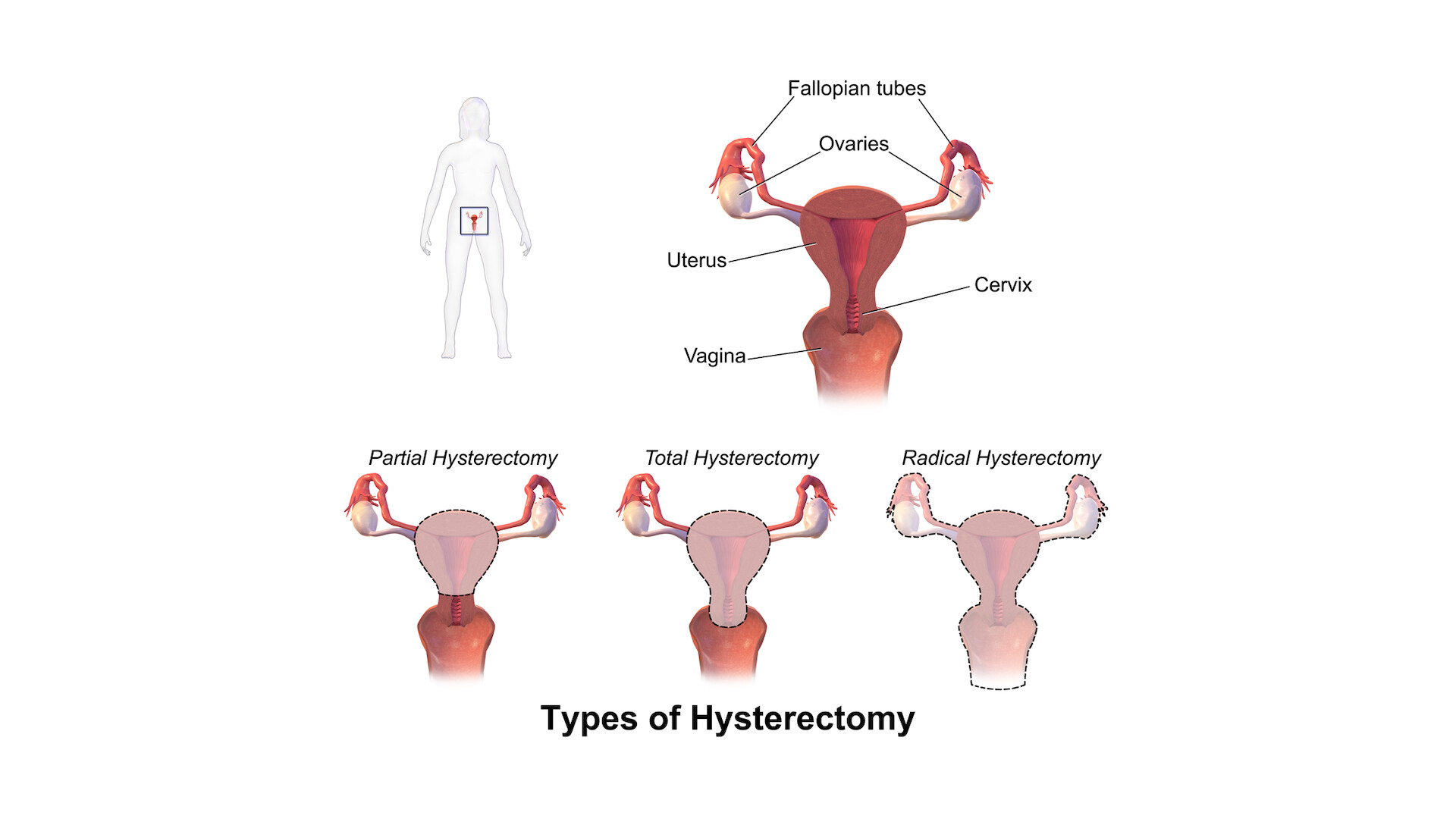 Images After Total Hysterectomy What To Expect After Hysterectomy
