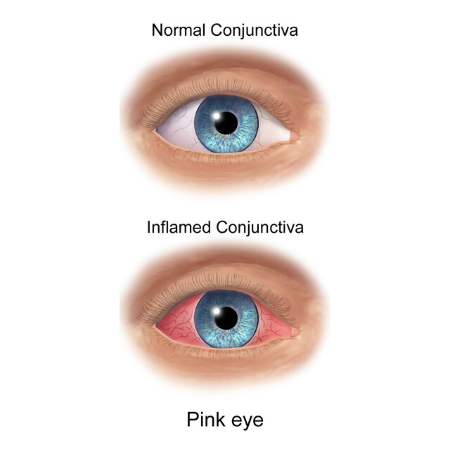 Trachoma Conjunctivitis