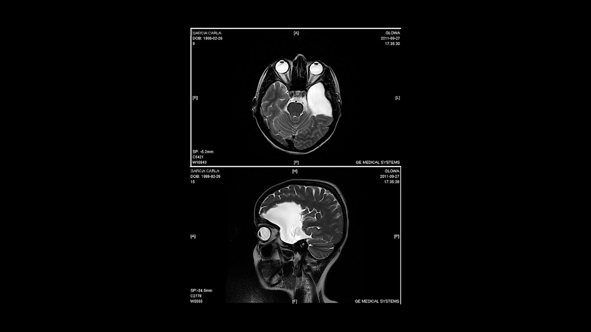 Arachnoid Cysts Storymd