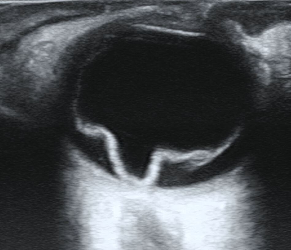 Retinal Detachment Ultrasound Elderly Man Presents With Acute Onset