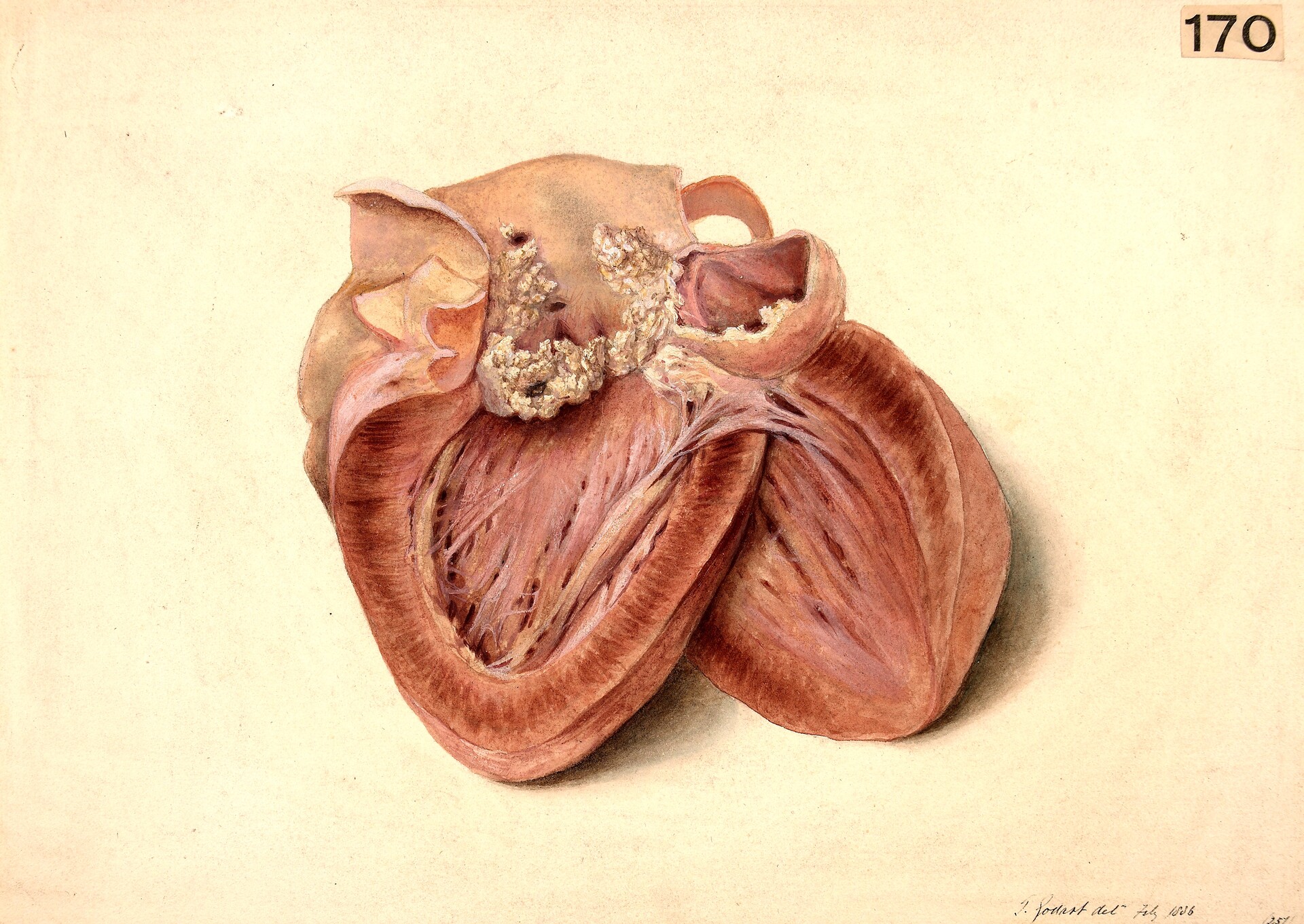 Endocarditis StoryMD endocarditis-storymd